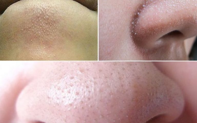 Mụn Chỉ Là Gì? Nguyên Nhân Và Cách Điều Trị Hiệu Quả